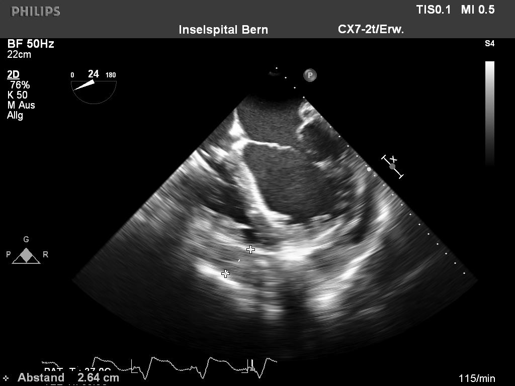 Perikardtamponade – Tamponade - Universitätsklinik für Intensivmedizin